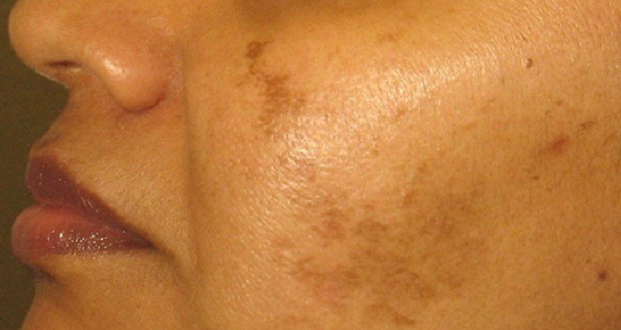 Débarrassez-vous des taches brunes et de l’hyperpigmentation avec deux ...
